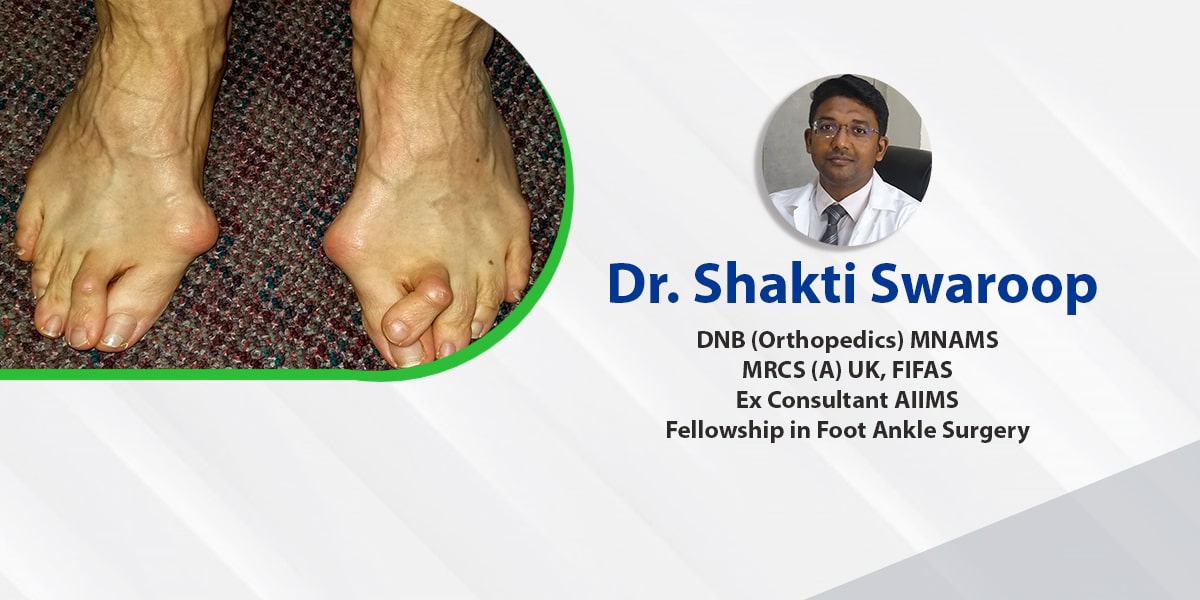Ankle injuries are very common in active population - Dr. Shakti Swaroop