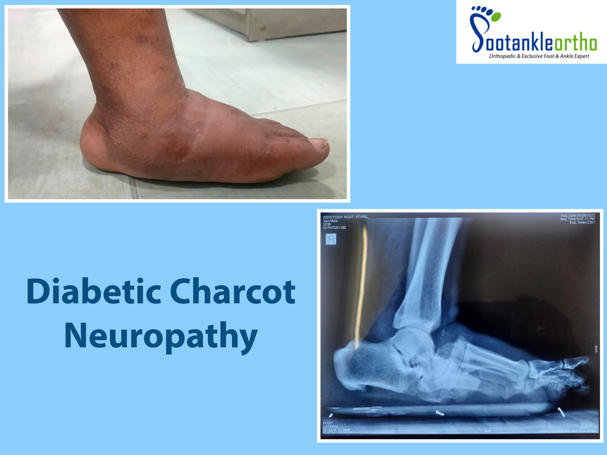 Diabetic Charcot Neuropathy - Foot & Ankle – Footankleortho - Dr ...