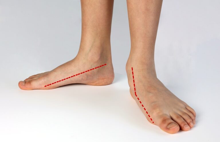 Understanding Flat Feet : How a Foot and Ankle Surgeon Can Help Relieve ...